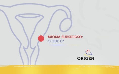 Mioma subseroso: o que é? » Clínica Origen | Fertilização in Vitro