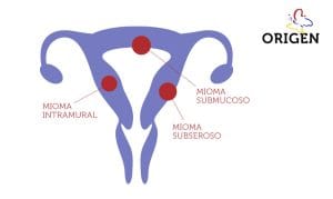 Classificação dos miomas: conheça melhor a doença » Clínica Origen ...