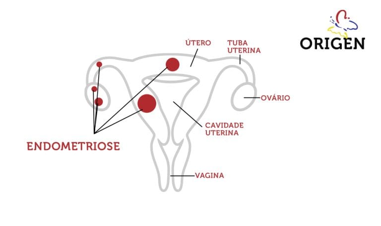 O que são ligamentos uterossacros e qual a relação com a endometriose ...